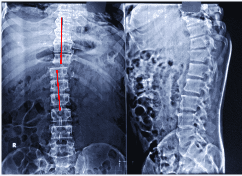 Spine Fracture Stabilization | Spine Sure Clinic